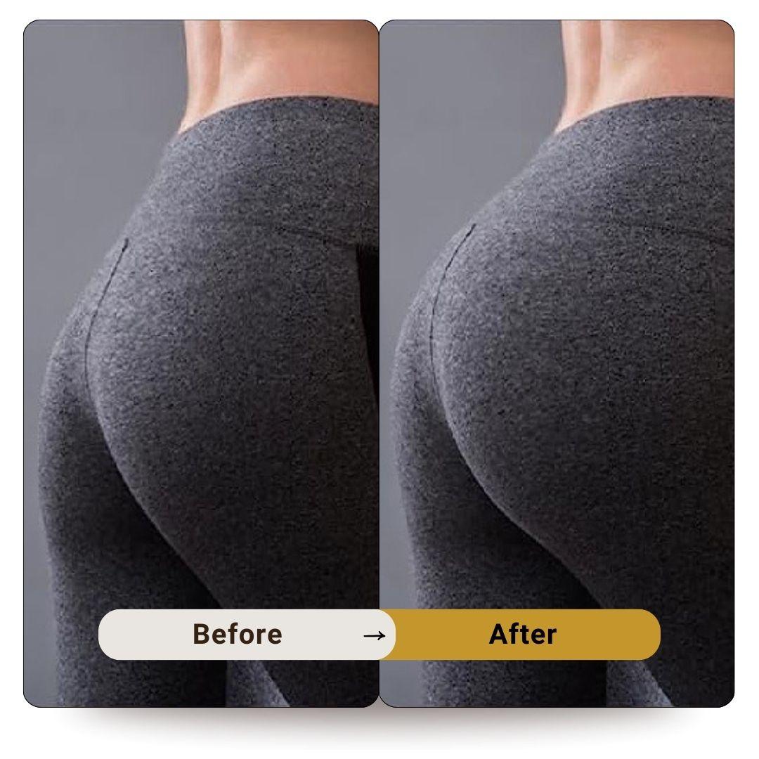 Butt Filler Dubai | Non-Surgical Butt Lift, Hip Dip Fillers