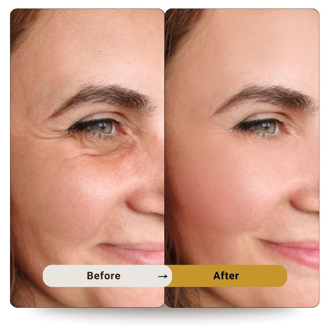 Full Face Botox Dubai | Botox Treatment Elite Body Home