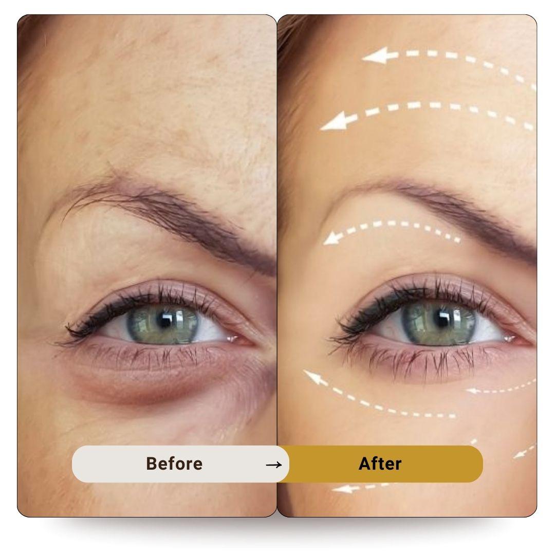 Full Face Botox Dubai | Botox Treatment Elite Body Home