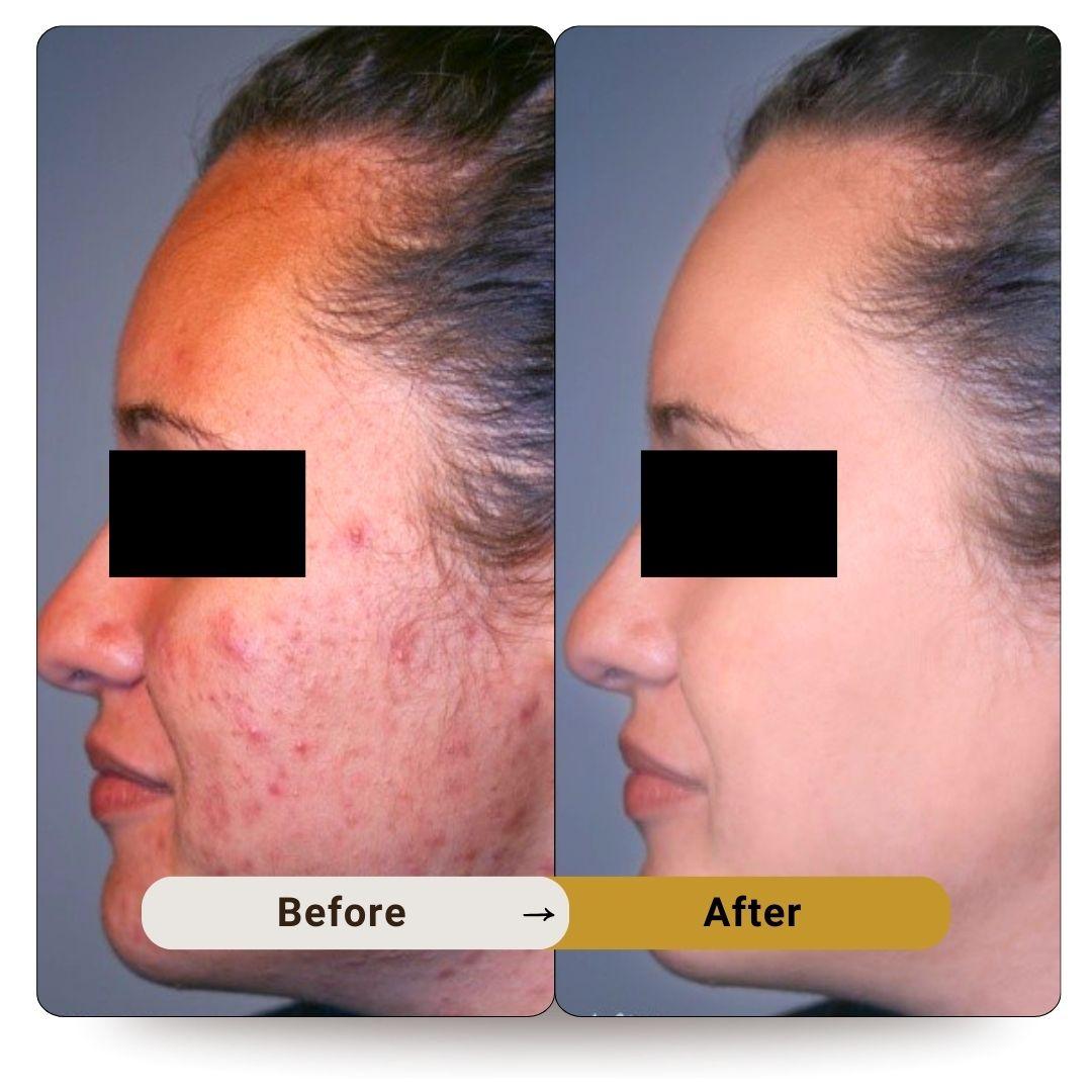 Acne Scars Removal | Elite Body Home, Jumeirah 1, Dubai