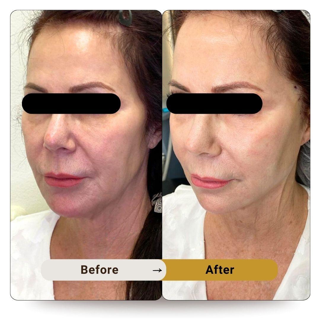 Facial Rejuvenation Treatment by Threads | Elite Body Home